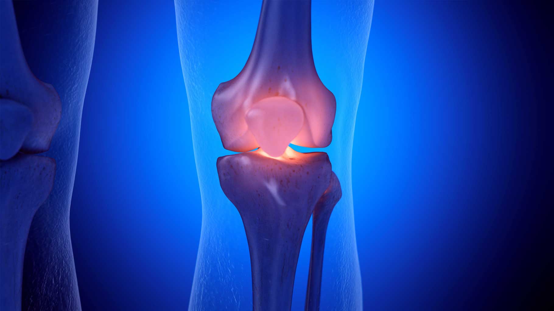 Do Gel Injections Work for Bone-on-Bone Knees - Joint Relief Institute